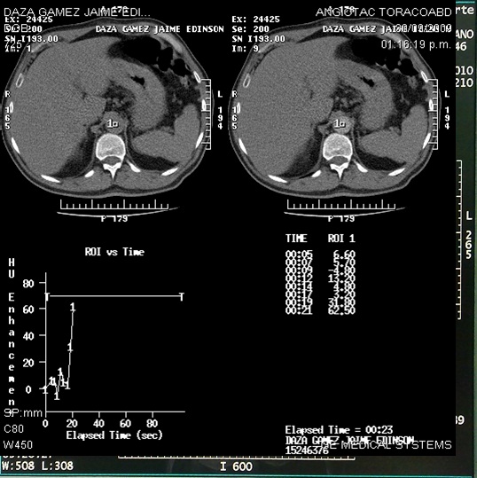 ANGIO TC OMARIS ESCOBAR: ANGIOTEC TORAX ADOMEN