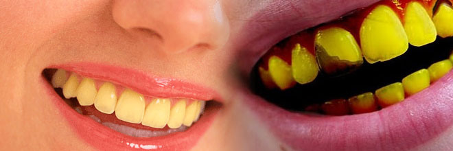 Factor Having Yellowish Teeth ~ health and care