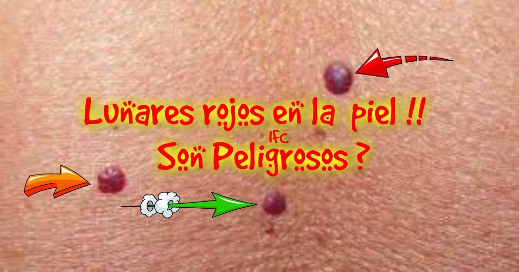 Tips y reflexiones para la vida: Lunares rojos en la piel: ¿A qué se deben?