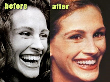Julia Roberts Plastic Surgery Before and After Botox Injection and Nose ...