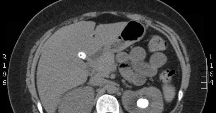 Emergency Medicine Visual Diagnosis: Flank Pain