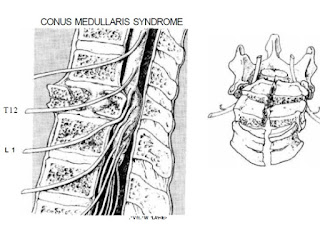 Info Sehat: Spinal Cord Injury (SCI)