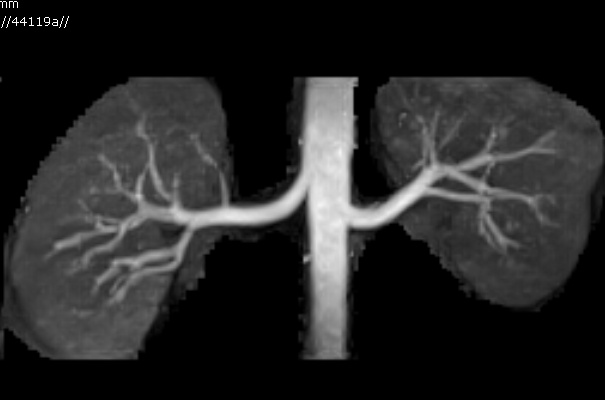 My Radiology World: Non-contrast MRA of ArterIes and Veins