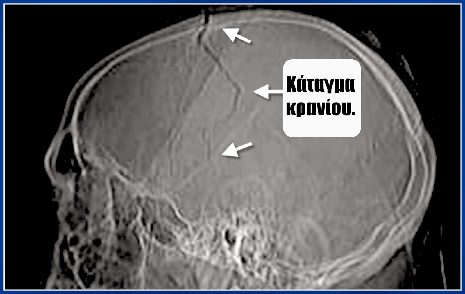 Κωνσταντίνος Χ. Δαβανέλος: Οξύ επισκληρίδιο αιμάτωμα.