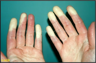 Raynaud’s Disease – The MedSchool Project