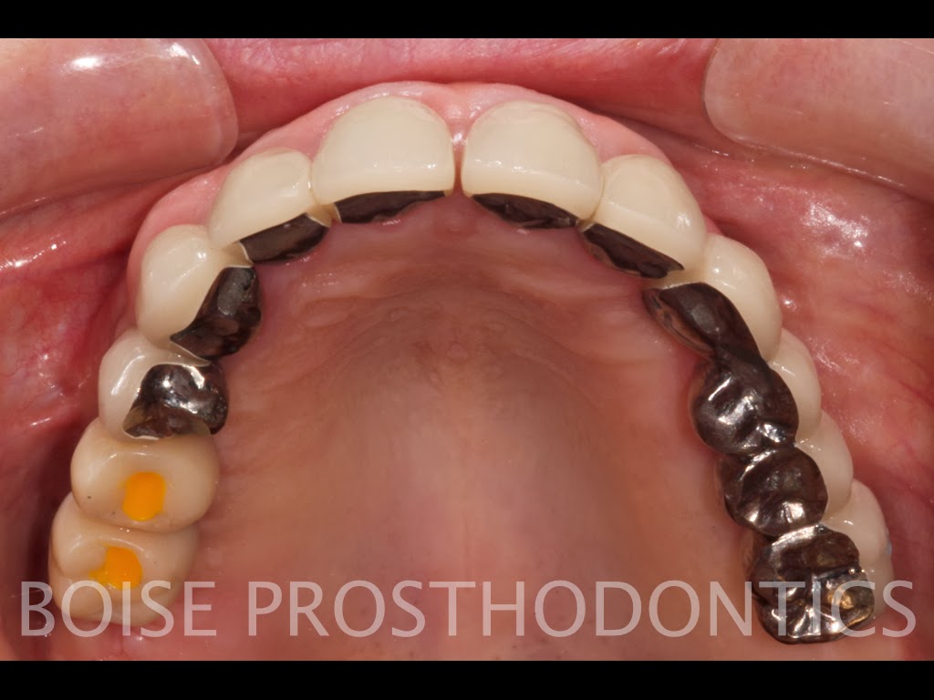 Boise Idaho Prosthodontics: Posterior Provisional Zimmer Implant ...