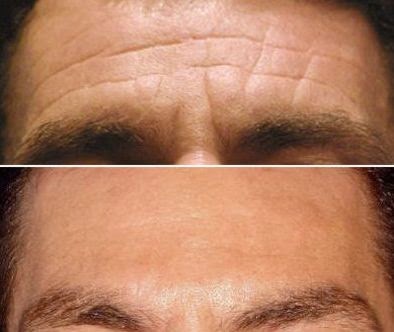 Erase And Reduce Brow Creases At Home Naturally With Face Exercises: Do ...