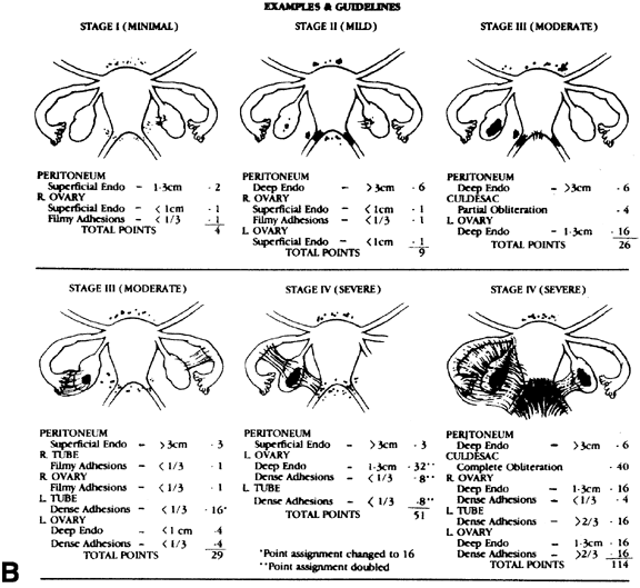 Enorca: Endometriozė