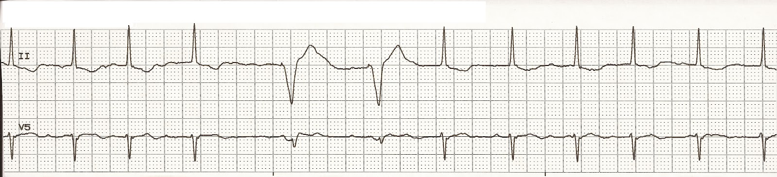 EKG Rhythm Strip Quiz 20