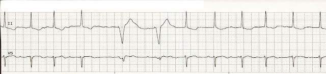 EKG Rhythm Strip Quiz 20