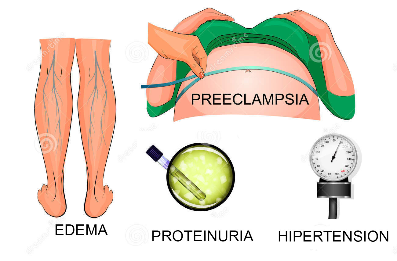 Caduceo Dorado PREECLAMPSIA caduceo-dorado-preeclampsia