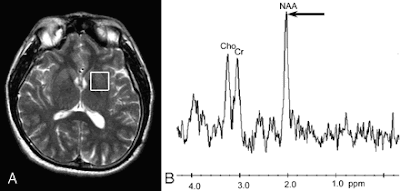 MRI& CT Signs: Normal MRS