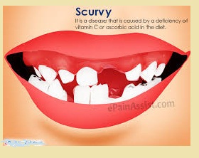 What is the Scurvy Disease?