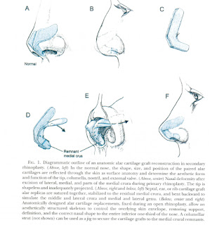 Nose Revision Surgery and Surgeons: Anatomic reconstruction of the alar ...