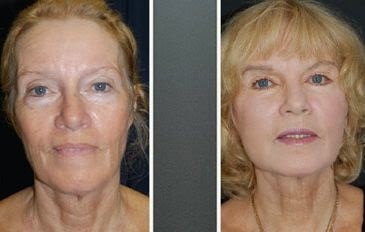 Workouts For The Face And Neck For Spectacular Anti-Aging Skin Care ...