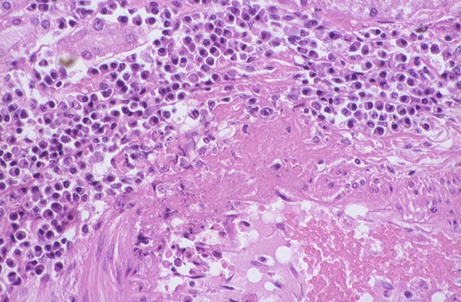 The Arts, Sciences and Medicine: TUMOR INFILTRATING LYMPHOCYTES (TILs)