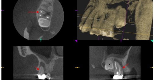 CBCT Scan: Maxillary Vertical Fracture Case Study