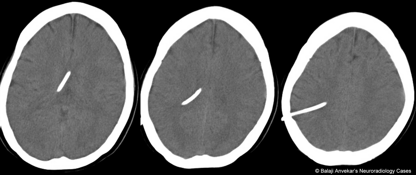 Dr Balaji Anvekar FRCR: Slit Ventricle Syndrome