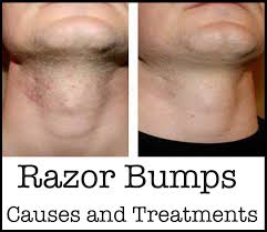 Best quotes for you: How To Get Rid Of Razor Burn Fast On Armpits, Legs ...