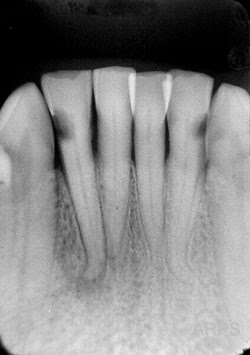 INTERPRETACION DE CARIES RADIOGRAFICAMENTE: La caries radiográficamente