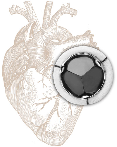 seppfaessler ブログ - blog: 人工心臓弁 Prosthetic heart valve
