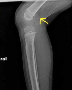Physiological periostitis versus Trampoline Injury-Plain Xray - Sumer's ...