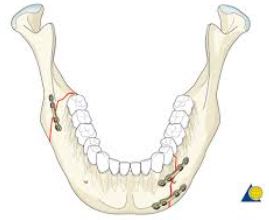 KSJBIO: #130 Distraction Osteogenesis Surgery (Mandibular Distraction ...