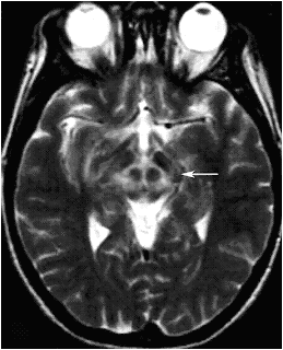 Image Bank: Face of Panda sign in Wilson's disease