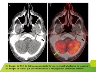 Papel da TEP-CT* (tomografia por emissão de positrões) em pacientes com ...