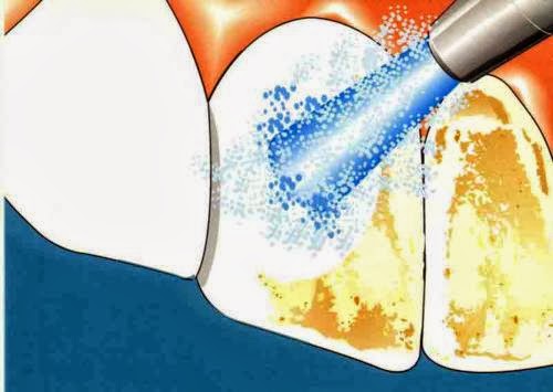 Tip´s Dentales: PROFILAXIS DENTAL