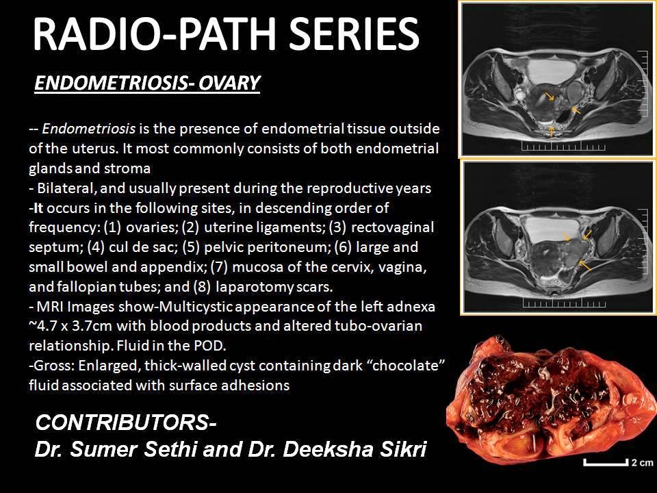 Endometriosis-Radio-Path Series - Sumer's Radiology Blog