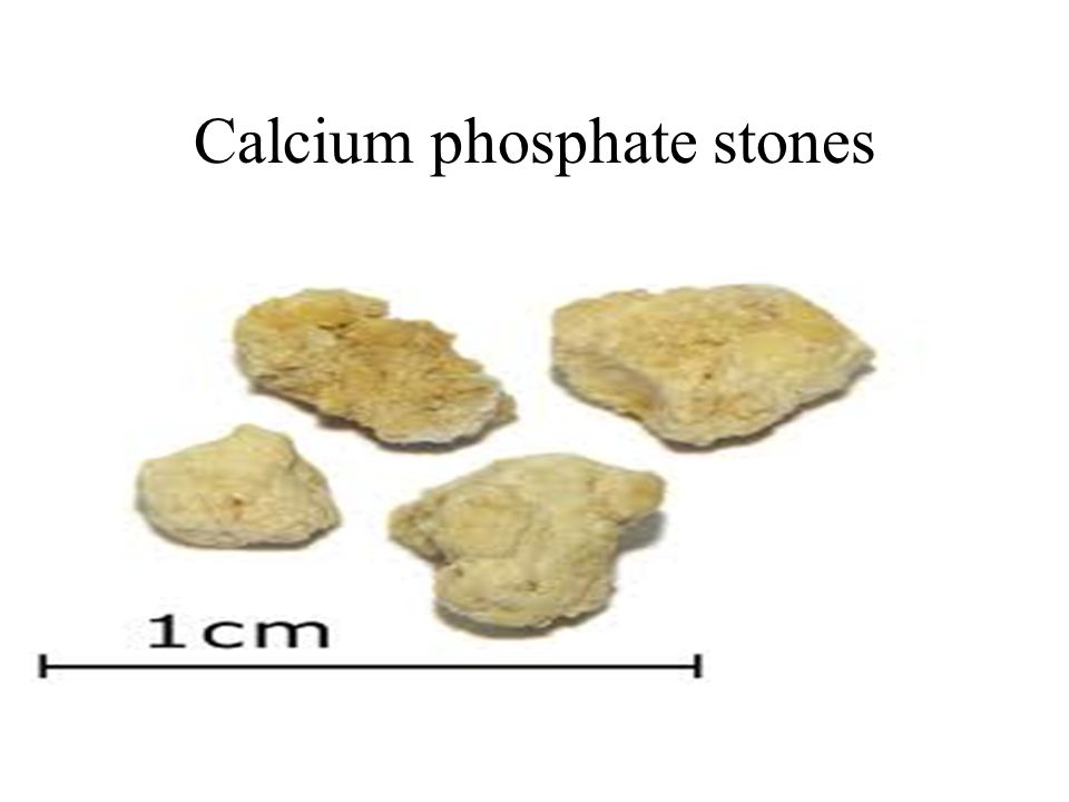 2. Phosphate Stone (15%)