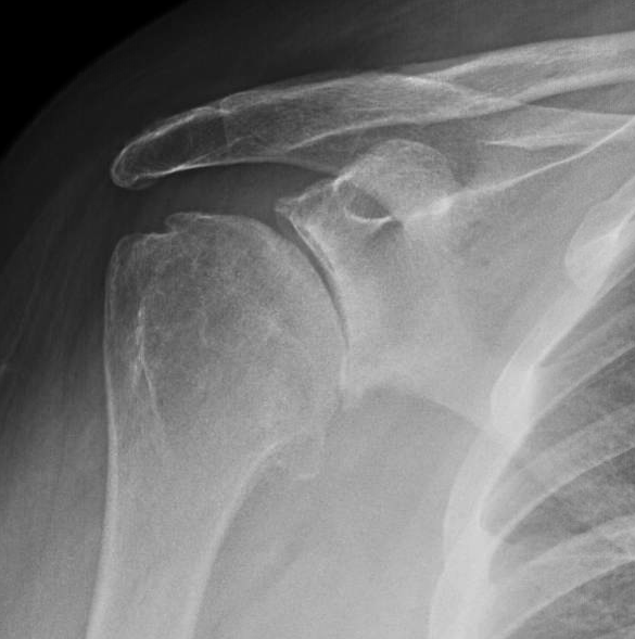 UW Shoulder and Elbow Academy: B2 glenoid, are special implants necessary?