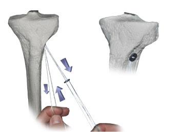 El Blog de Isa y Juan: Fractura de la espina tibial