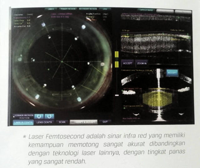 Informasi Tentang Katarak & Bladeless laser katarak