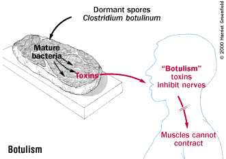Botulism