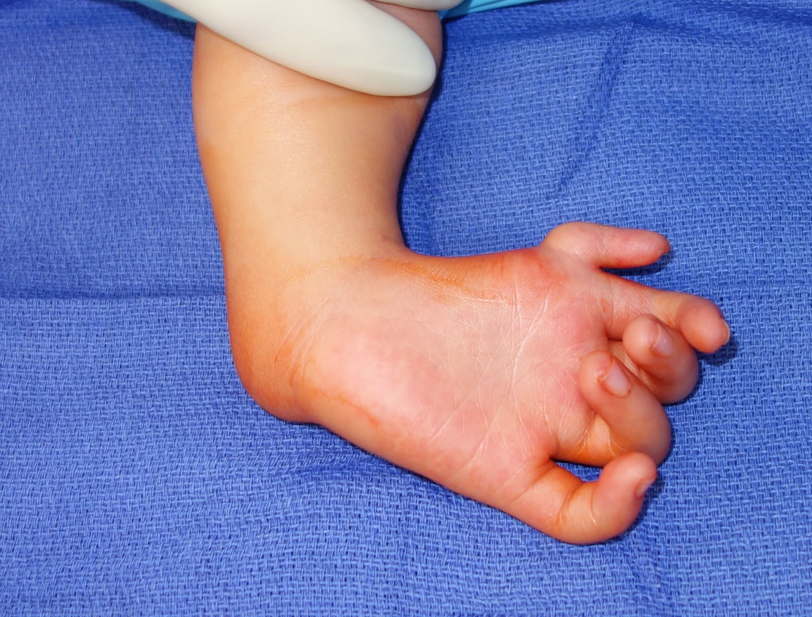 Severe Radial Deficiency- No slowing this kid down! | Congenital Hand ...