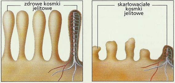 Poradnik pozytywnego jedzenia: CHOROBA TRZEWNA CZYLI CELIAKIA