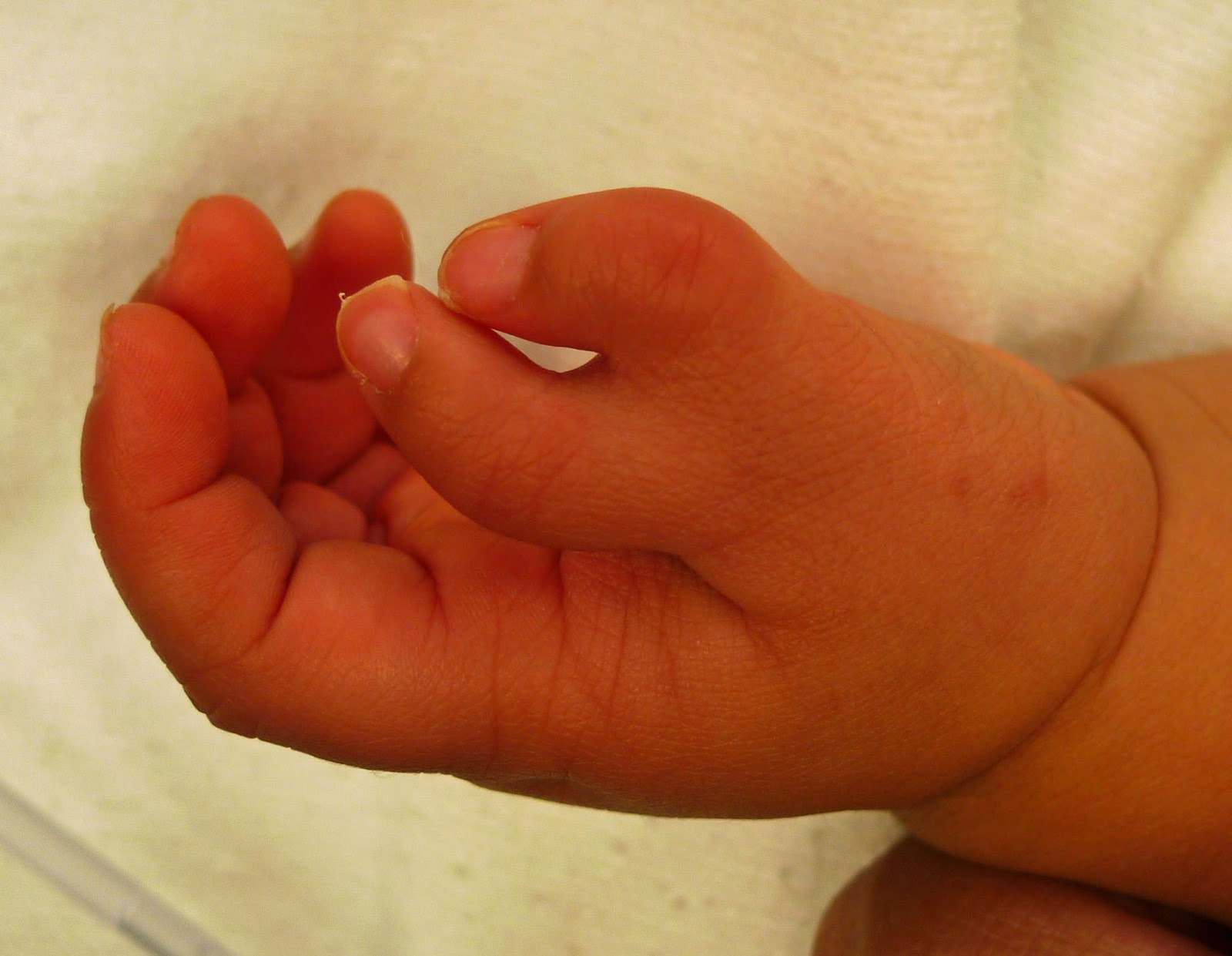 Extra Thumb | Congenital Hand and Arm Differences | Washington ...