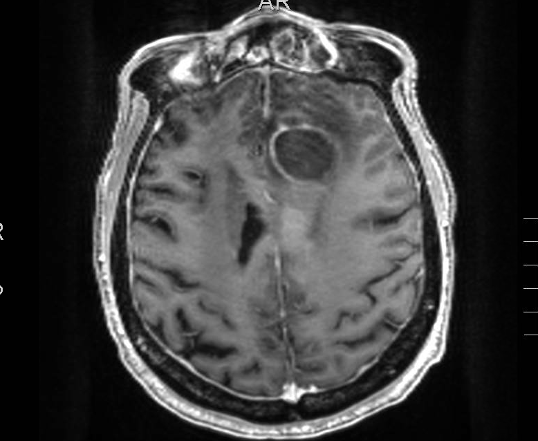 Cases and Images in Infectious Disease: Brain Abscess