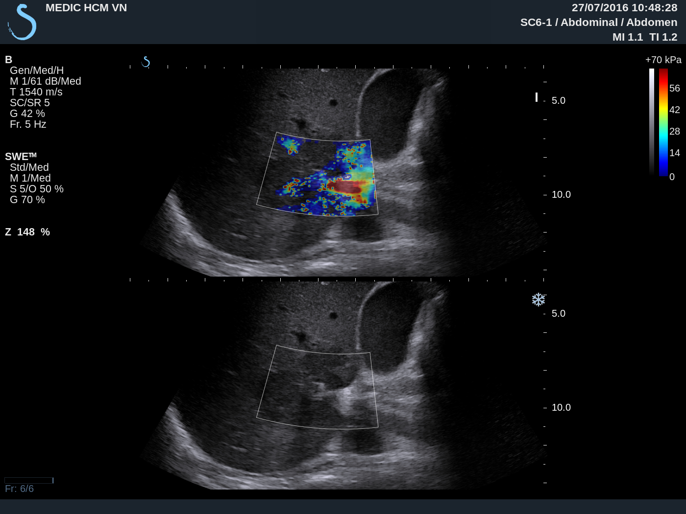 VIETNAMESE MEDIC ULTRASOUND: CASE 387: LIVER ABSCESS DUE TO FISHBONE ...