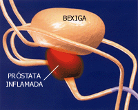 Ciências e Saúde: Saúde da próstata