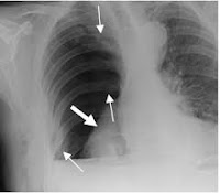 VENTILACION MECANICA EN TORAX INESTABLE