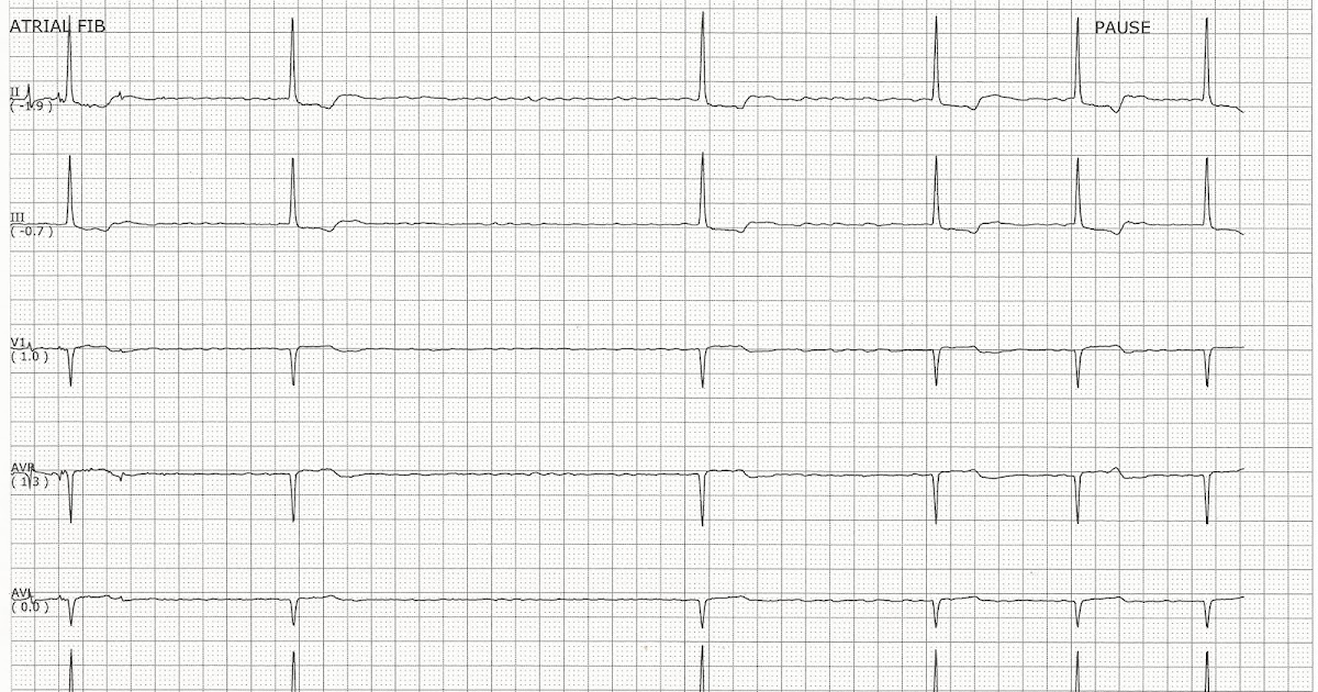 Atrial fibrillation with a slow ventricular response and arrest