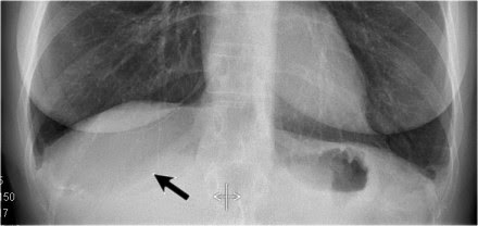 Chest Medicine Made Easy-Dr Deepu: Basics of Chest X Ray Part 3 ...