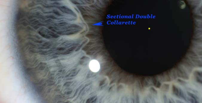 Modern & Multidimensional Iridology: The Dynamics of the Collarette ...