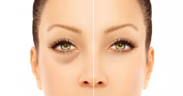 10 Best Natural Tips to Cure Eyes Puffiness or Under Eye Bags - Best ...