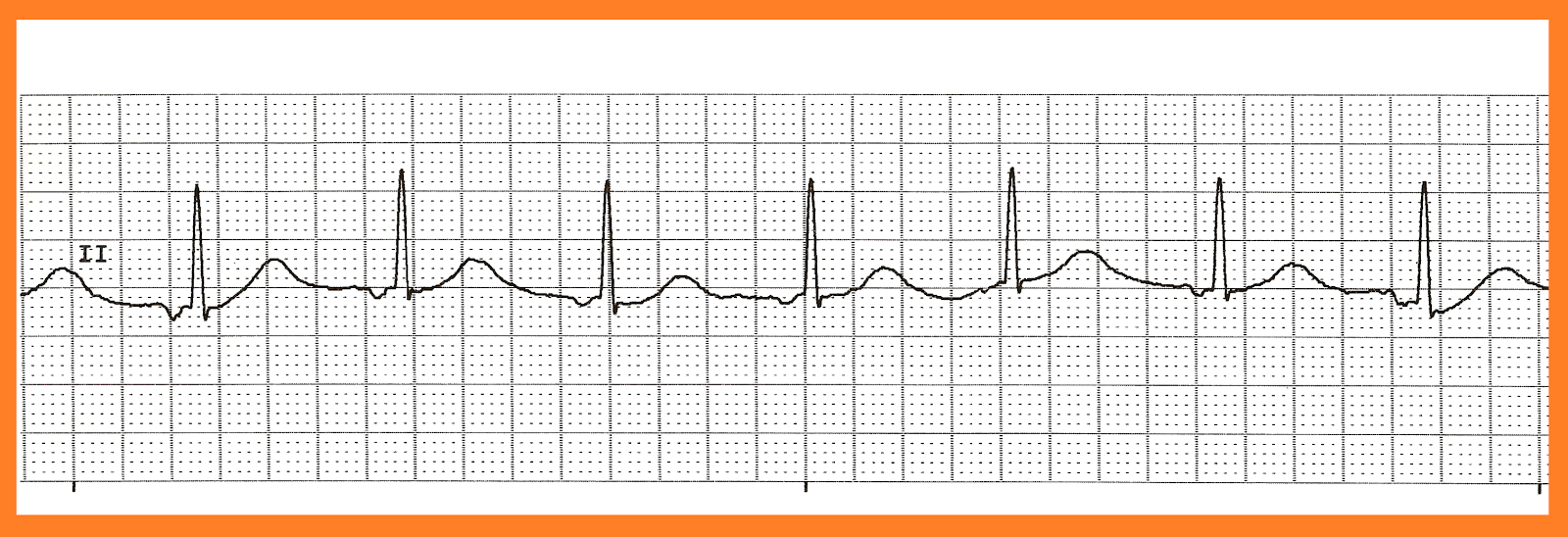 Various Accelerated Junctional Rhythms