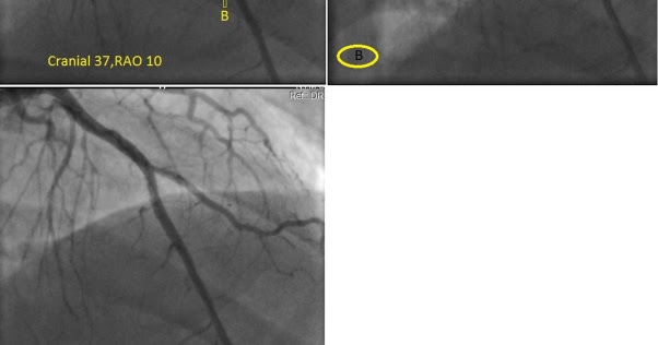 HealthforHeart: Thrombus aspiration catheter is a Dottering balloon