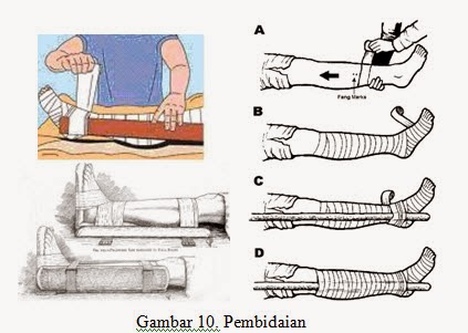 LAPORAN PENDAHULUAN FRAKTUR